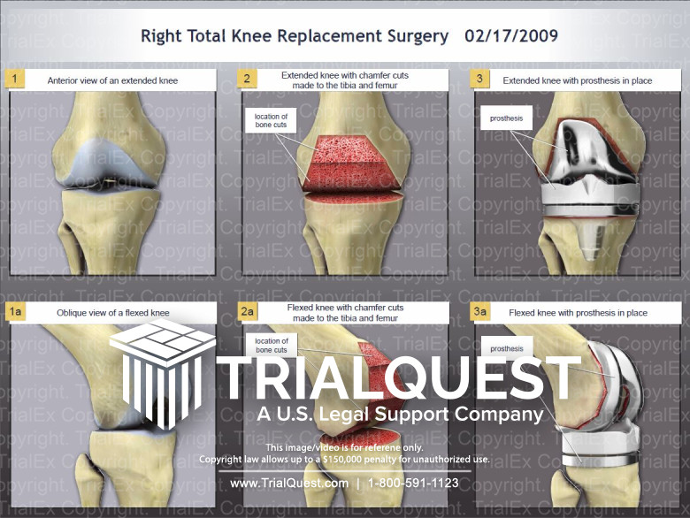 Right Total Knee Replacement Surgery TrialQuest Inc Right Total Knee Replacement Surgery TrialQuest Inc