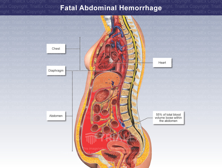 Fatal Abdominal Hemorrhage TrialQuest Inc Fatal Abdominal Hemorrhage TrialQuest Inc