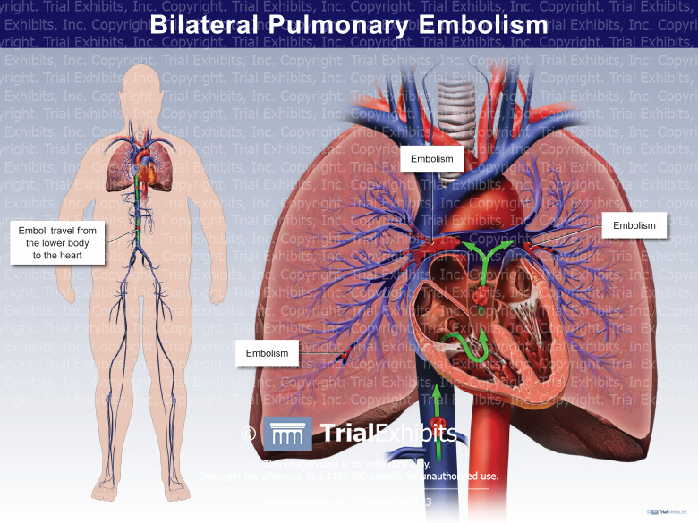 Bilateral Pulmonary Embolism TrialQuest Inc Bilateral Pulmonary Embolism TrialQuest Inc