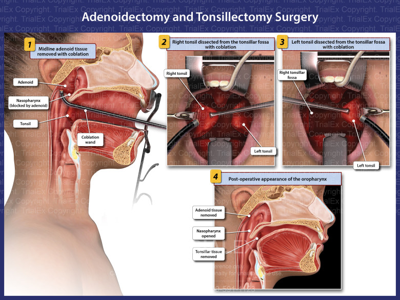 Tonsillectomy And Adenoidectomy Tonsillectomy And Adenoidectomy