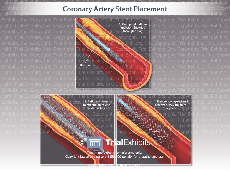 Coronary Artery Stent Placement Coronary Artery Stent Placement