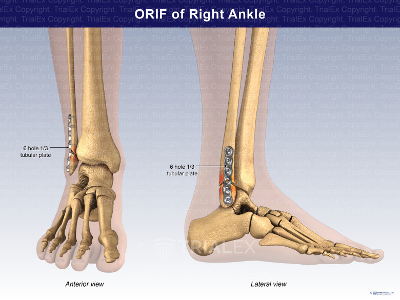 ORIF Of Right Ankle ORIF Of Right Ankle
