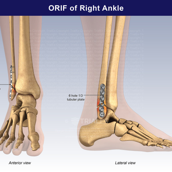 Medical Legal Exhibits Legal Animations Trial Graphics Tria 