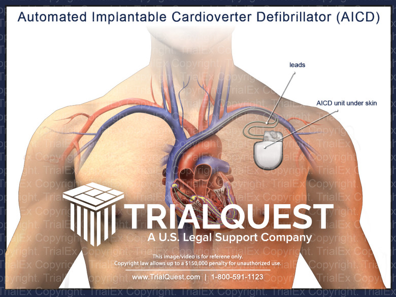 Automated Implantable Cardioverter Defibrillator AICD TrialQu Automated Implantable Cardioverter Defibrillator AICD TrialQu