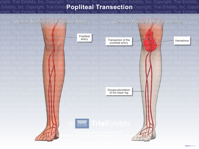 Popliteal Transection