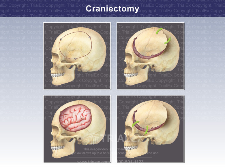 Craniectomy TrialQuest Inc Craniectomy TrialQuest Inc