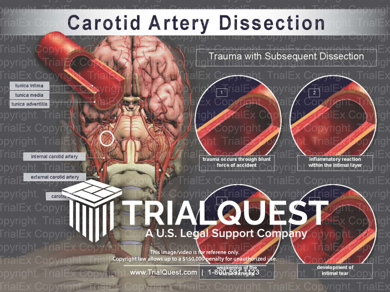Carotid Artery Dissection TrialQuest Inc Carotid Artery Dissection TrialQuest Inc