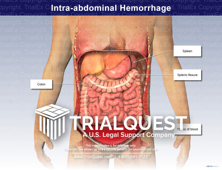 Intra abdominal Hemorrhage Intra abdominal Hemorrhage