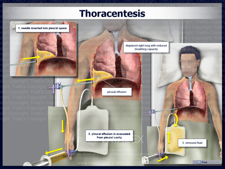 Thoracentesis TrialQuest Inc 