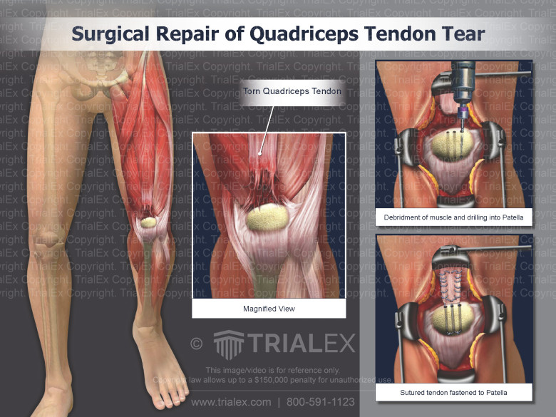 Quadriceps Tendon Repair Quadriceps Tendon Repair