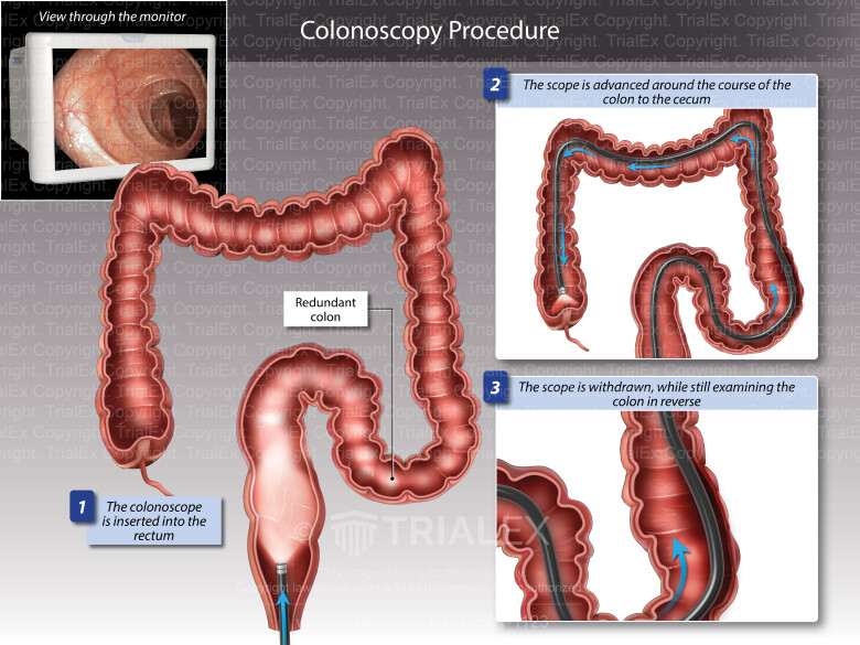 Colonoscopy Procedure With Redundant Colon Colonoscopy Procedure With Redundant Colon