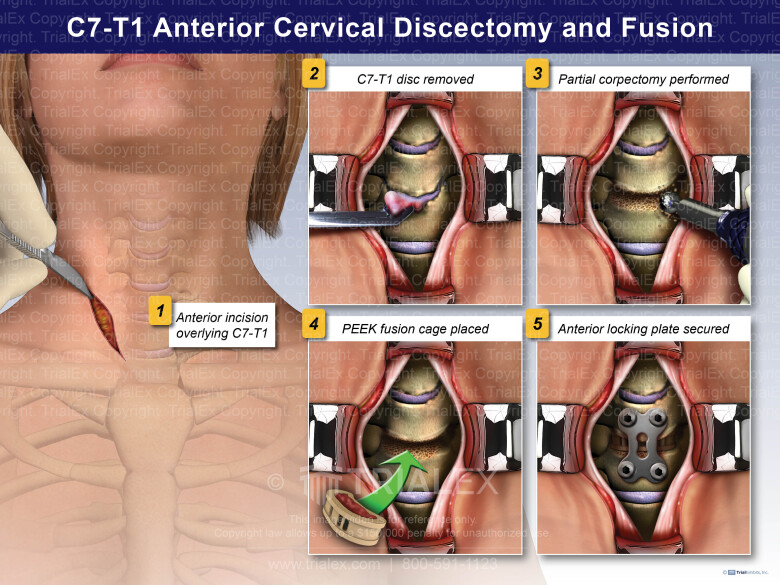 What Is A Fusion Procedure At Keith Ramsay Blog What Is A Fusion Procedure At Keith Ramsay Blog