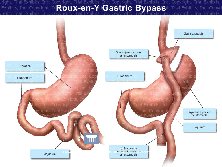 Roux en Y Gastric Bypass TrialQuest Inc Roux en Y Gastric Bypass TrialQuest Inc