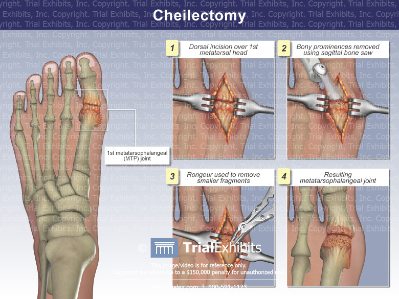Cheilectomy TrialQuest Inc Cheilectomy TrialQuest Inc