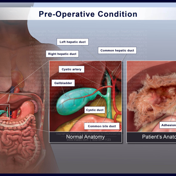 Medical Legal Exhibits - Legal Animations & Trial Graphics - Tria...