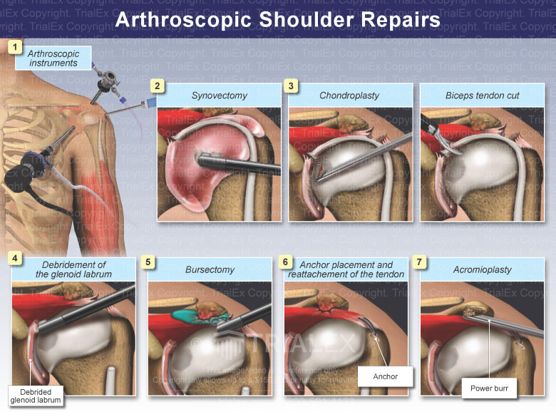 When Can You Drive After Arthroscopic Shoulder Surgery At Maddison When Can You Drive After Arthroscopic Shoulder Surgery At Maddison