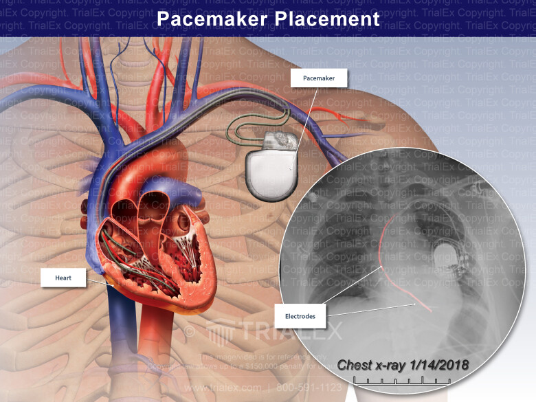 Pacemaker Placement TrialQuest Inc Pacemaker Placement TrialQuest Inc