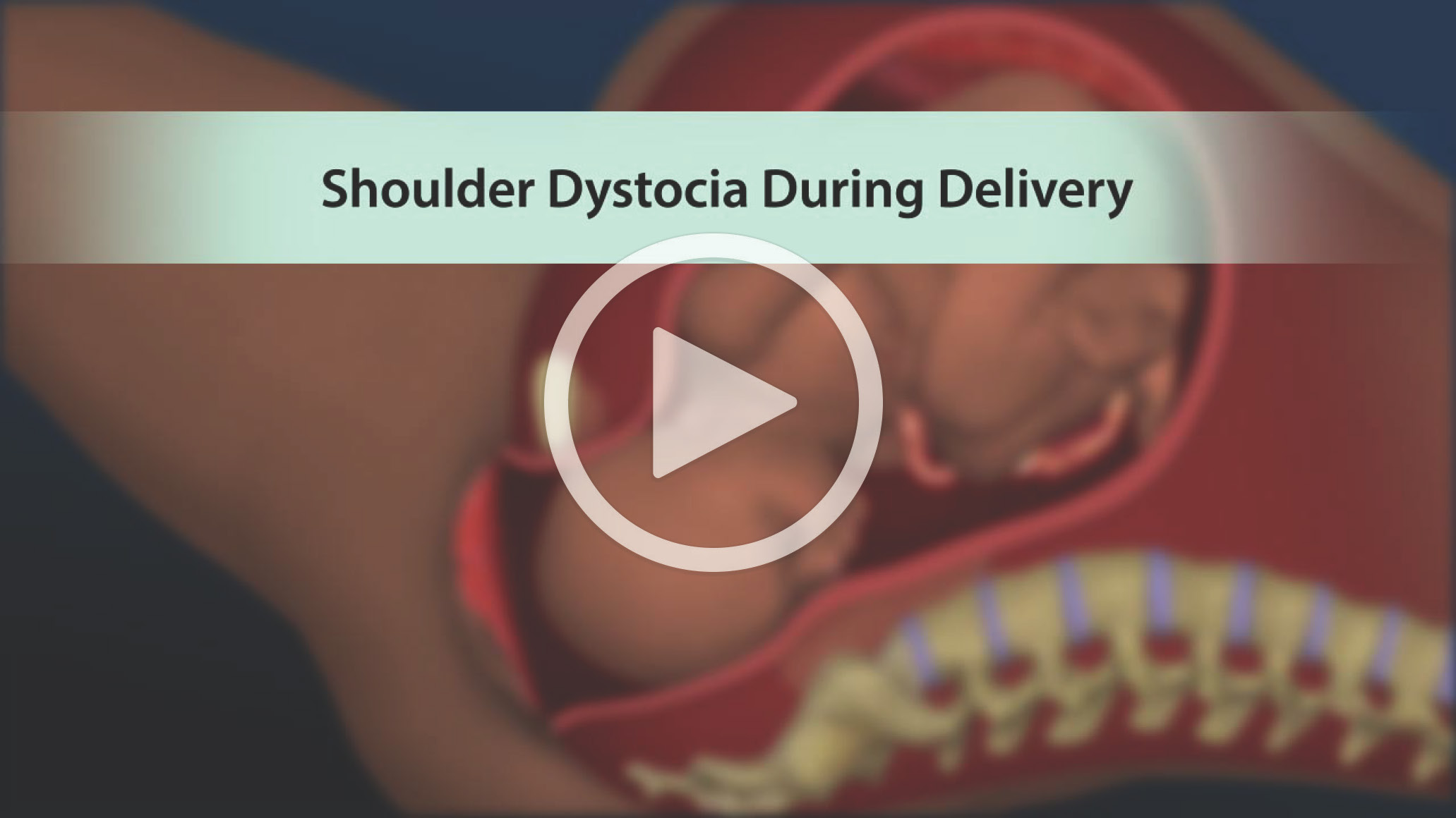 Shoulder Dystocia Turtle Sign