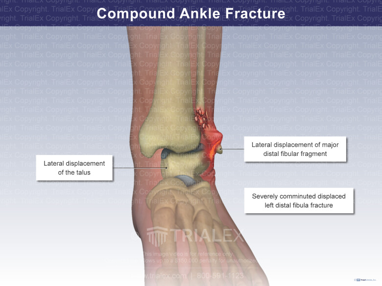 What Is A Compound Fracture Clearance Outlet Brunofuga adv br What Is A Compound Fracture Clearance Outlet Brunofuga adv br