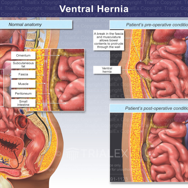 Ventral Hernia TrialQuest Inc 