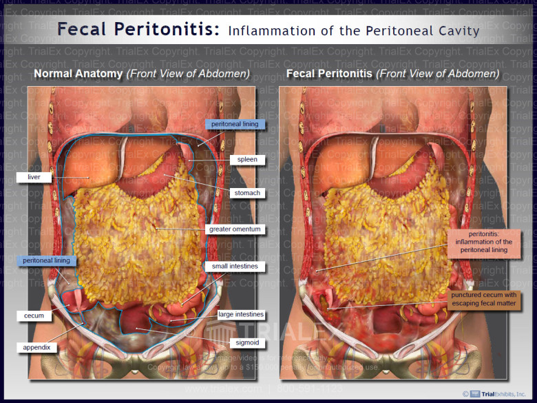 Peritonitis Of The Small Intestine Photograph By 51 OFF Peritonitis Of The Small Intestine Photograph By 51 OFF