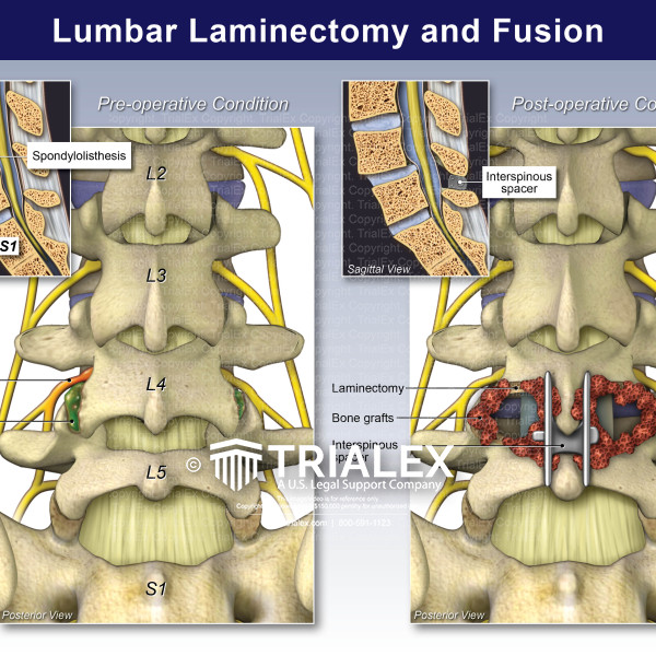 Medical Legal Exhibits Legal Animations Trial Graphics Tria 