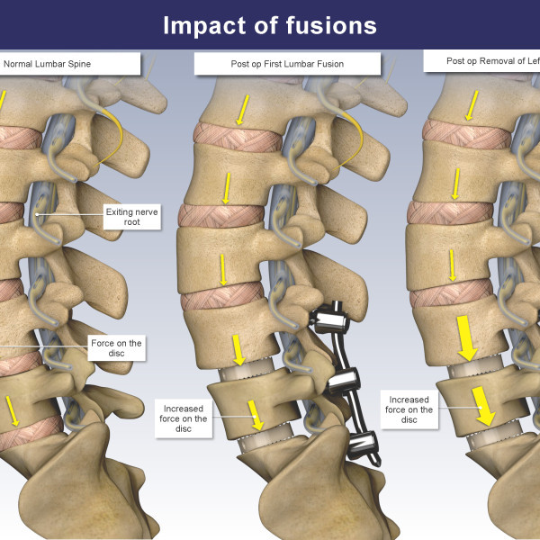 Post Op Pelvis Trial Exhibits Inc 