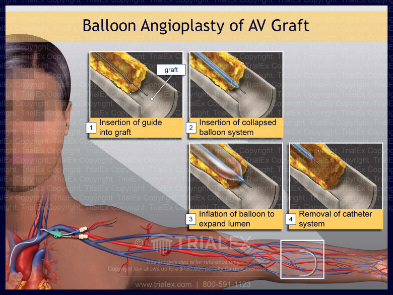 Balloon Angioplasty Of AV Graft TrialQuest Inc Balloon Angioplasty Of AV Graft TrialQuest Inc