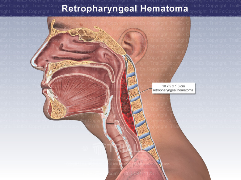 Retropharyngeal Hematoma Retropharyngeal Hematoma