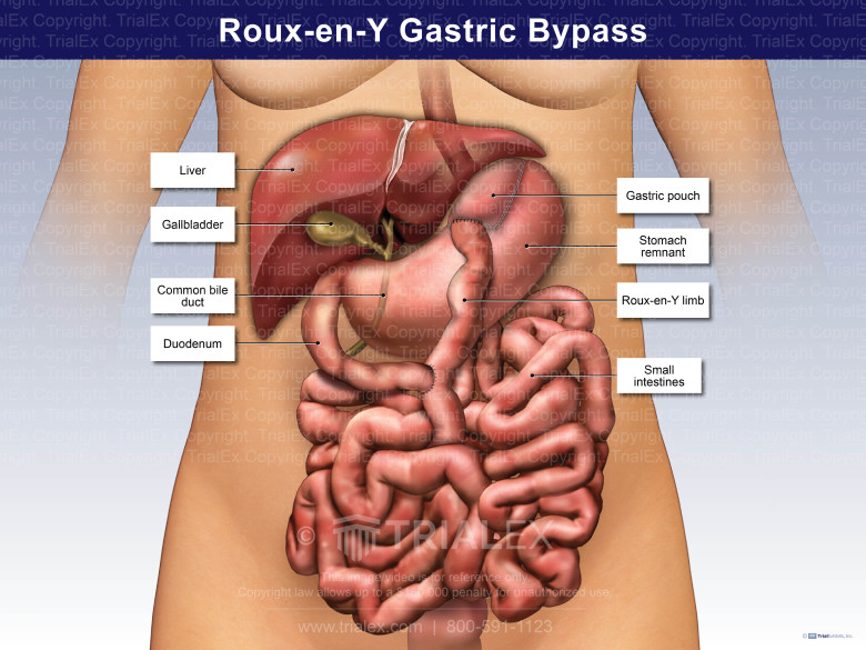 Roux en Y Gastric Bypass TrialQuest Inc Roux en Y Gastric Bypass TrialQuest Inc