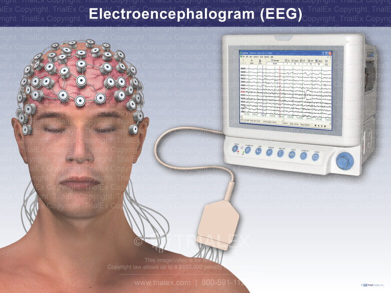 Electroencephalogram EEG Electroencephalogram EEG