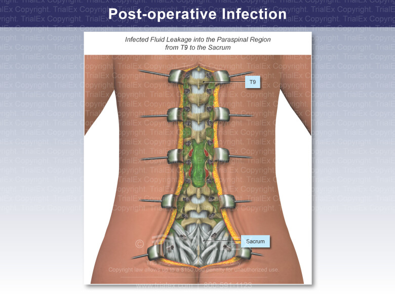 Post operative Infection TrialQuest Inc Post operative Infection TrialQuest Inc