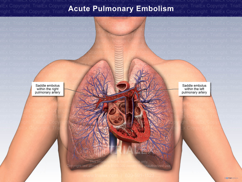 Acute Pulmonary Embolism Acute Pulmonary Embolism