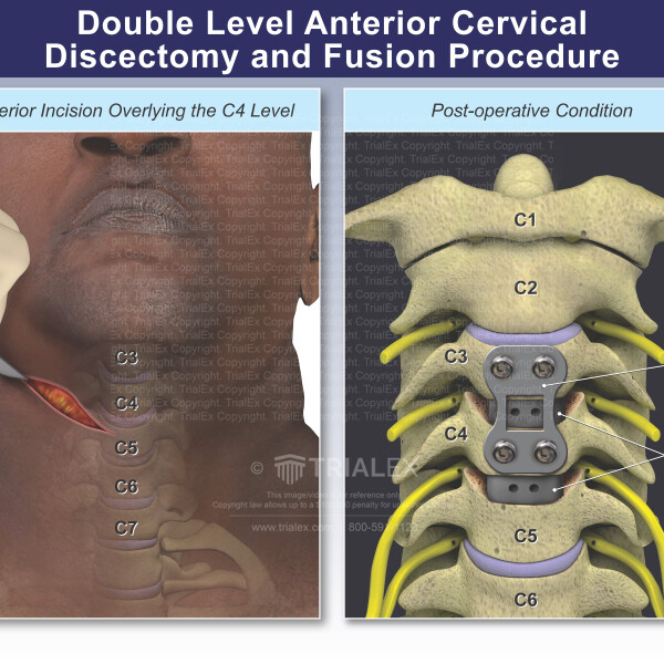 Medical Legal Exhibits Legal Animations Trial Graphics Tria 