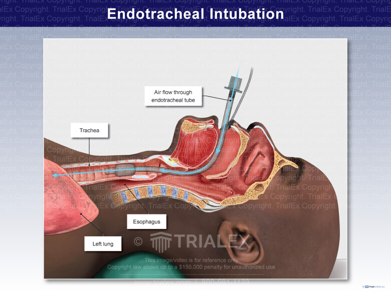 Endotracheal Intubation TrialQuest Inc Endotracheal Intubation TrialQuest Inc