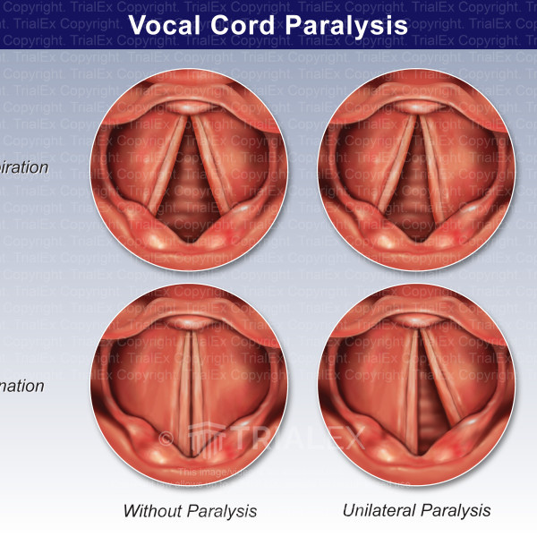 Vocal Cord Paralysis
