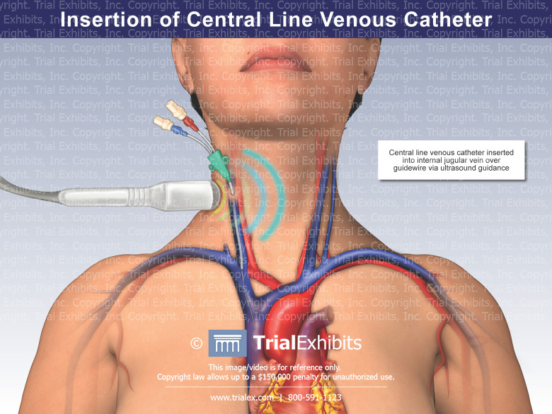 Insertion Of Catheter Into Internal Jugular Vein Trial 51 OFF