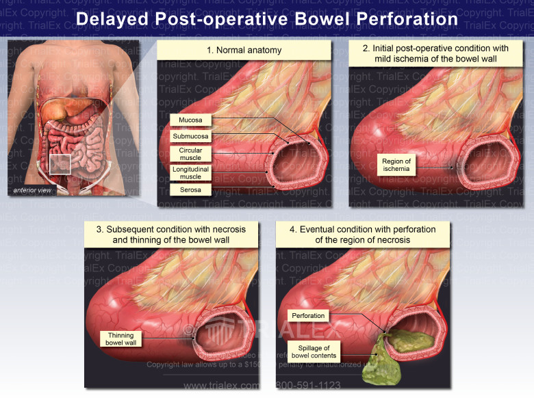 Delayed Post operative Bowel Perforation