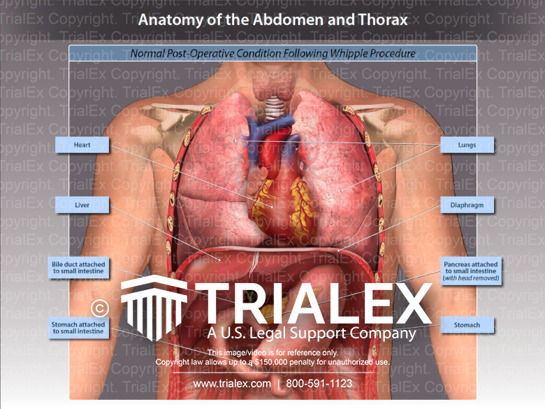 Abdomen And Thorax Post Whipple Procedure Trial Exhibits Inc Abdomen And Thorax Post Whipple Procedure Trial Exhibits Inc