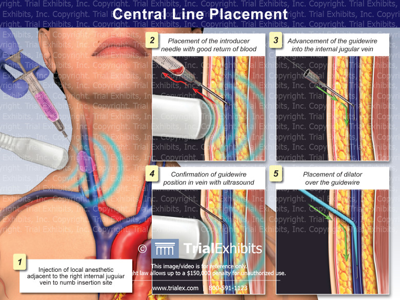 Confirming Central Venous Access Position Chest X Ray 60 OFF Confirming Central Venous Access Position Chest X Ray 60 OFF