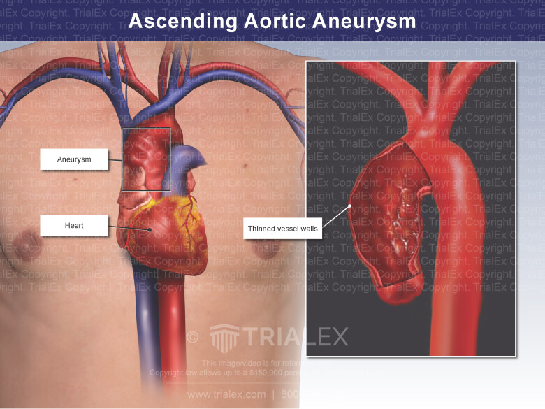 Ascending Aortic Aneurysm Trial Exhibits Inc 