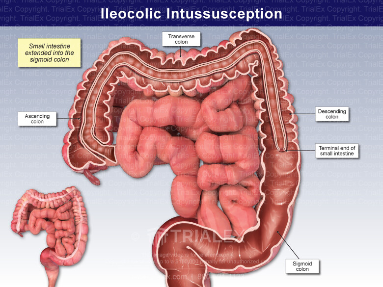 Ileocolic Intussusception TrialQuest Inc Ileocolic Intussusception TrialQuest Inc