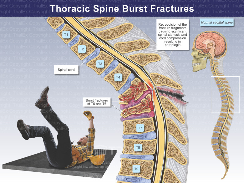 Thoracic Spine Burst Fractures TrialQuest Inc Thoracic Spine Burst Fractures TrialQuest Inc