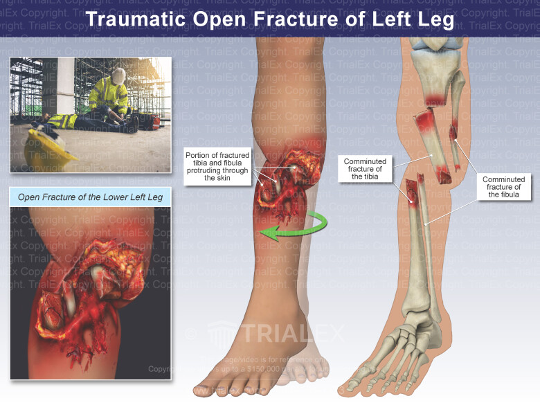 Traumatic Fracture Traumatic Fracture