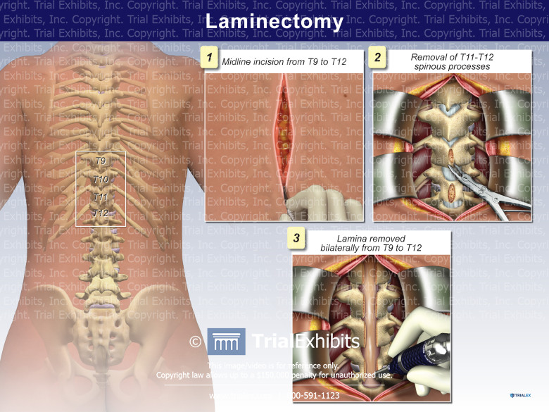 Laminectomy Laminectomy