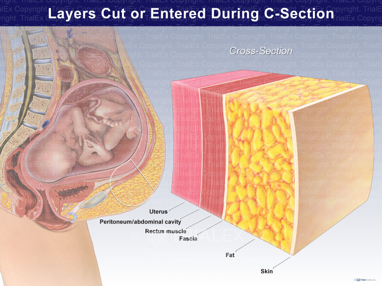 Caesarean Section Indications Classification TeachMeObGyn 56 OFF Caesarean Section Indications Classification TeachMeObGyn 56 OFF