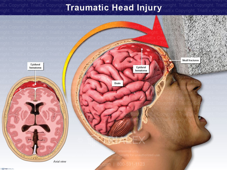 Epidural Brain Epidural Brain