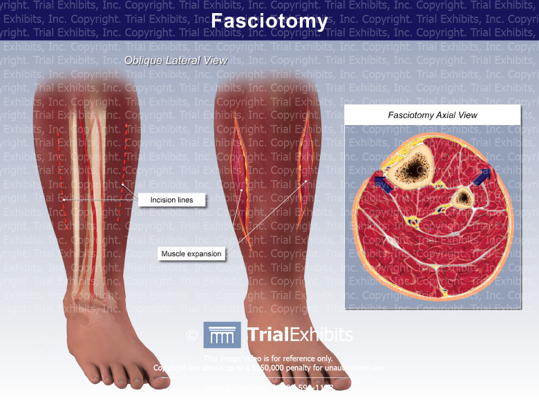 Fasciotomy TrialQuest Inc Fasciotomy TrialQuest Inc