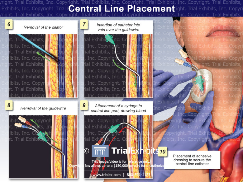 Ultrasound Guided Central Line Placement Made Easy 50 OFF