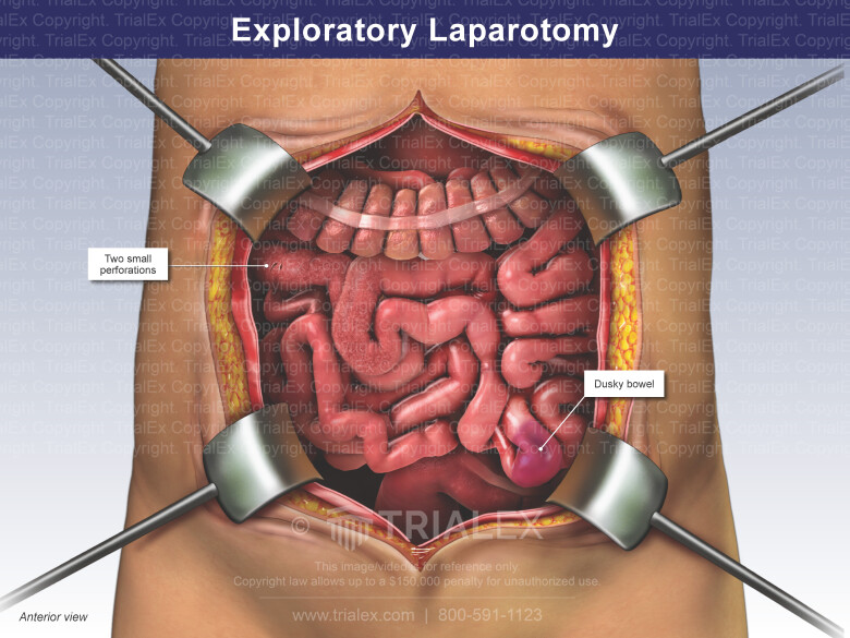 Exploratory Laparotomy TrialQuest Inc 